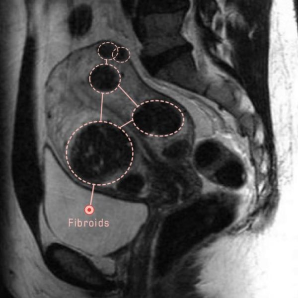 About Uterine Fibroids | Fibroid Institute