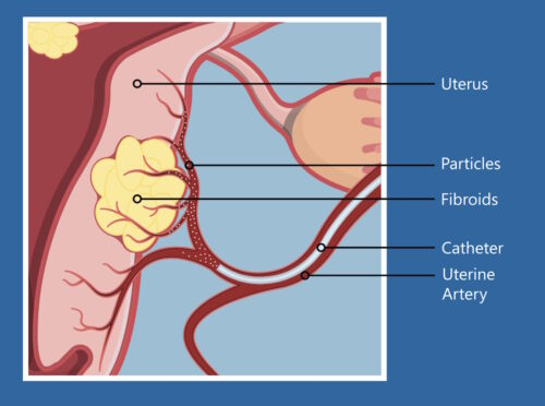 Uterine Fibroids and Stress | Fibroid Institute Texas
