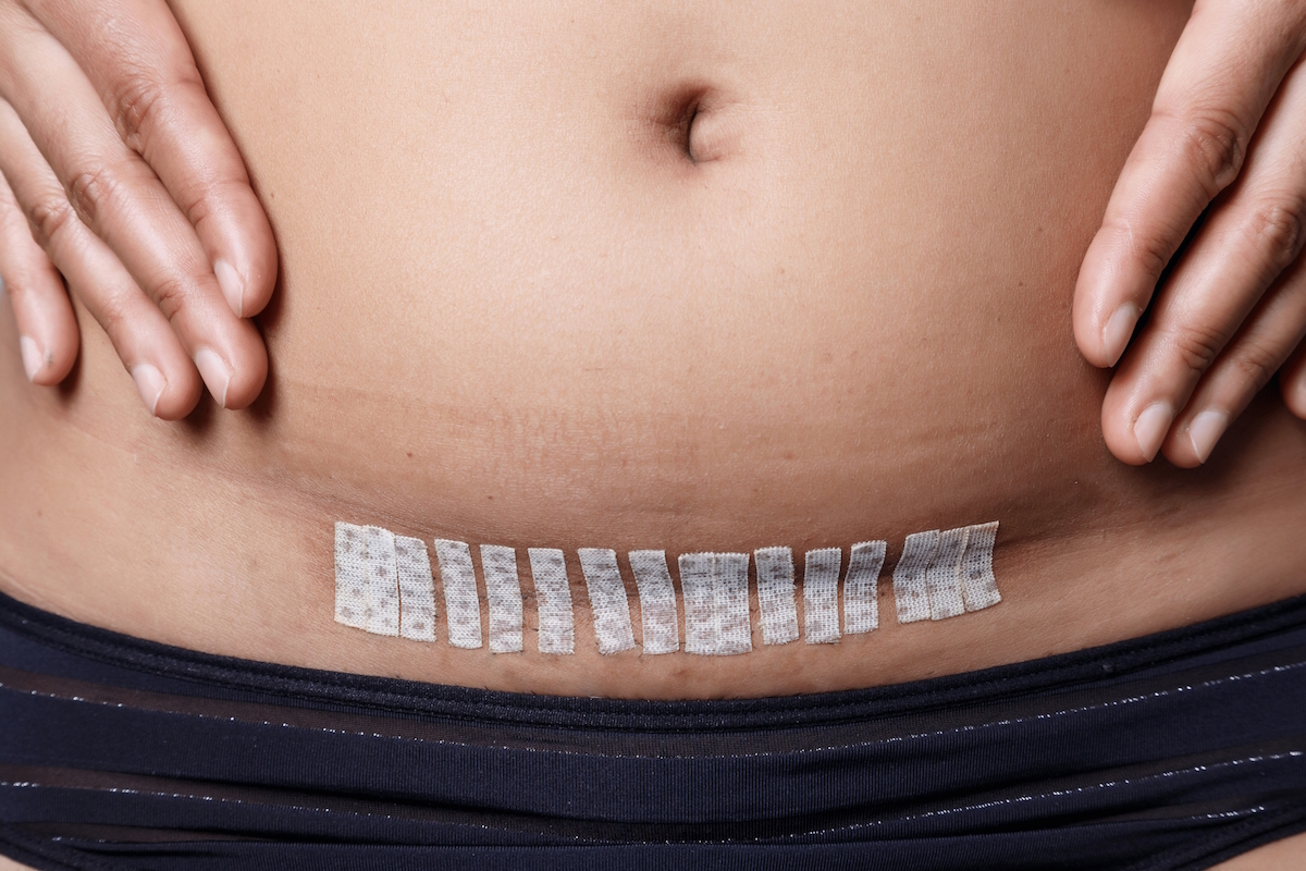 Fibroid Surgery Scars: Myomectomy vs Hysterectomy vs UFE
